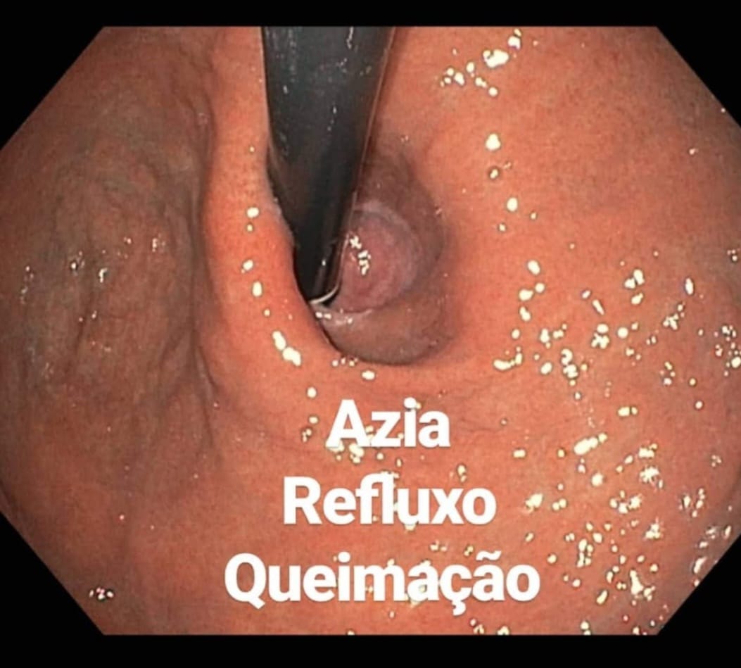 Endoscopia Digestiva Alta | Obesogastro